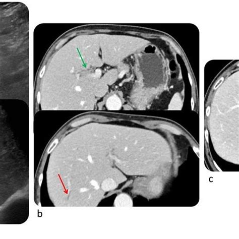 Complicated Immune Related Segmental Colitis With Diverticulosis