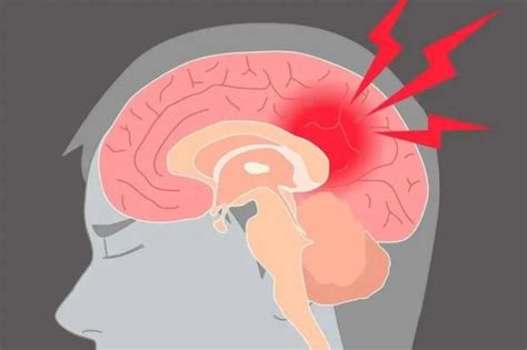 人类健康的第一杀手脑中风 澎湃号湃客 澎湃新闻 The Paper