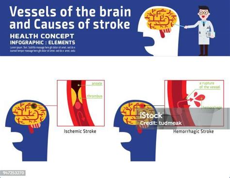 두뇌와 스트로크 Infographic 질병 의료 일러스트 레이 션의 원인의 선박 배너 헤더 의료 개념입니다 벡터 아이콘 플랫