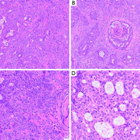 Synovial Sarcoma With Prominent Epithelioid Component A B The Download Scientific Diagram
