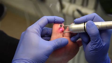 Wart Removal With K Laser Cube Youtube