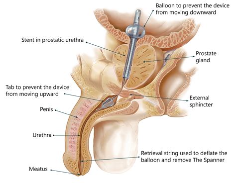 Srs Medical The Spanner® Stent Patient Information