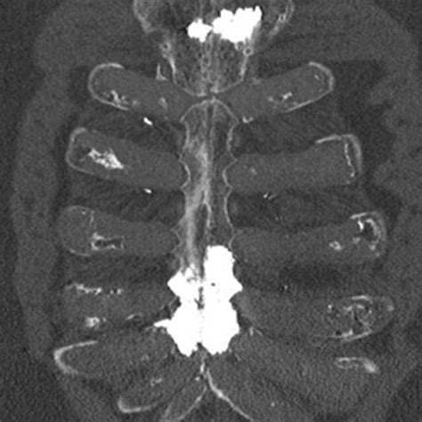 Post Operative Sagittal Computed Tomography Image Of Patient 1