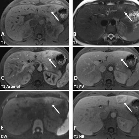 Method Of Vascular Count Each Picture Of The Subserosal Layer On Each