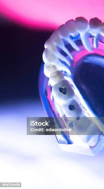 치과 의사 치과 치아 교육 각 치아 잇 몸 루트 임 플 란 트 부패 패 및에 나 멜을 보여주는 모델 3차원 형태에 대한 스톡 사진 및 기타 이미지 Istock