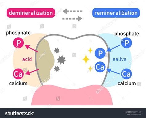 Orthodontic Treatment Demineralization At Patrick Herrod Blog