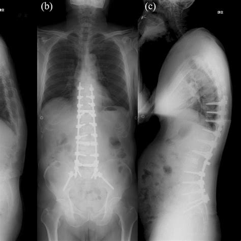 Case 2 A 72 Year Old Woman With Rigid L5 Kyphosis Deformity Due To