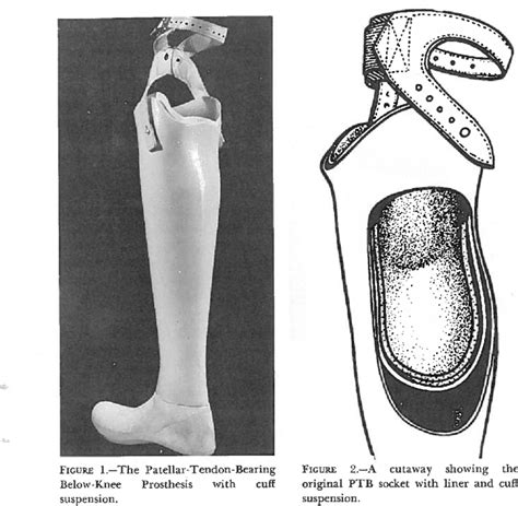 Below Knee Amputation Or Transtibial Amputation
