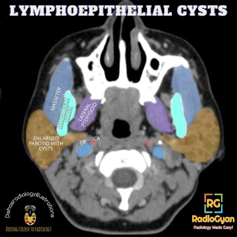 Submandibular Gland Cyst