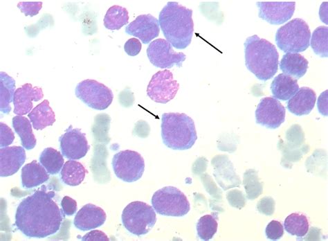 Bone Marrow Aspirate Smear Reveals Blasts Of Myeloid Lineage Along With