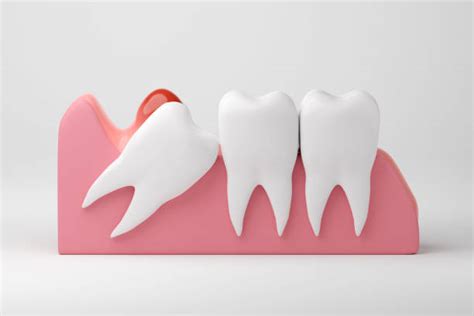 Your Complete Guide To Wisdom Tooth Removal What To Expect