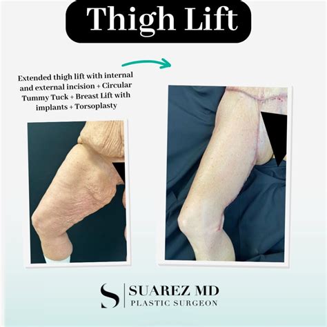 Best Thigh Lift In Tijuana Mexico Dr Luis Suarez Plastic Surgeon In