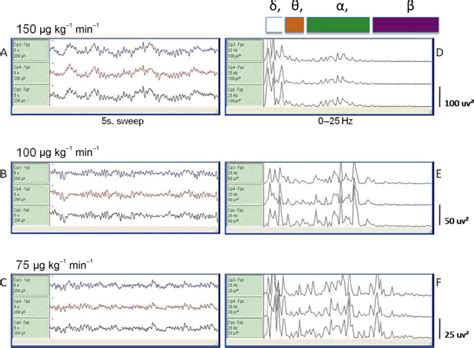Intraoperative Neuromonitoring In Paediatric Spinal Surgery Pmc