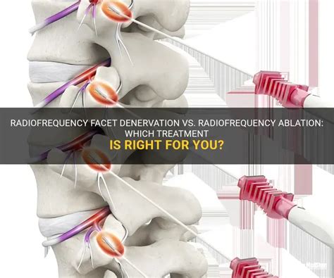 Radiofrequency Facet Denervation Vs Radiofrequency Ablation Which Treatment Is Right For You