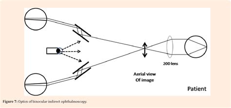 Indirect Ophthalmoscope Diagram