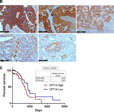 Cpt1a Is Highly Expressed In Ovarian Cancer And Its Expression