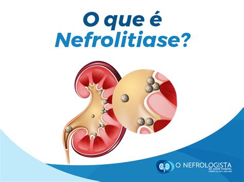 O Que é Nefrolitíase A Esquerda Librain