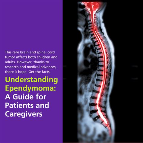 Understanding Ependymoma A Guide For Patients And Caregivers