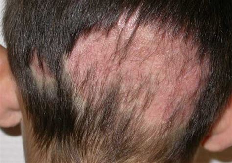 Hongos En El Cabello Esteticistas