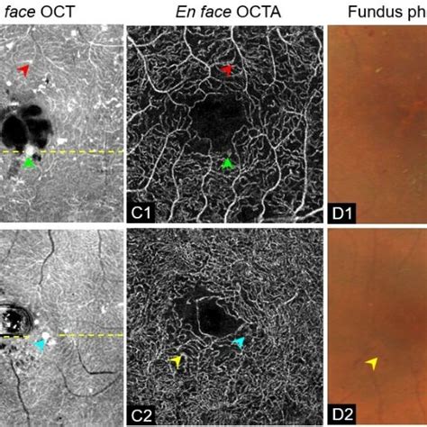 Microaneurysms Visualized By Oct Octa Fundus Photography Fp And