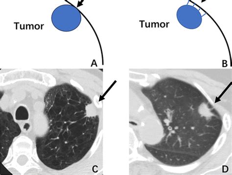 Ct Predictors Of Visceral Pleural Invasion In Patients With Nonsmall Cell Lung Cancers 30 Mm Or