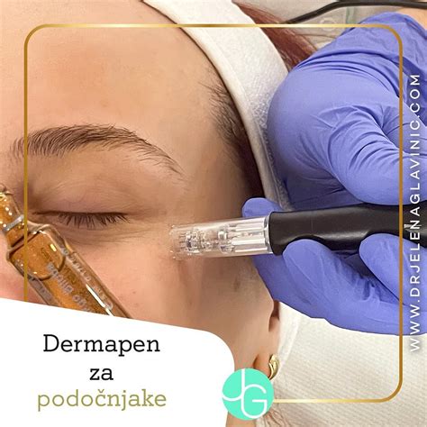 Dermapen Za Podočnjake Osmislili Dr Jelena Glavinić Facebook