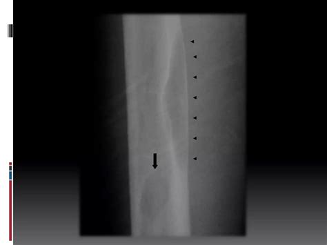Plain Radiological Findings Of Primary Hyperparathyrodism Pptx