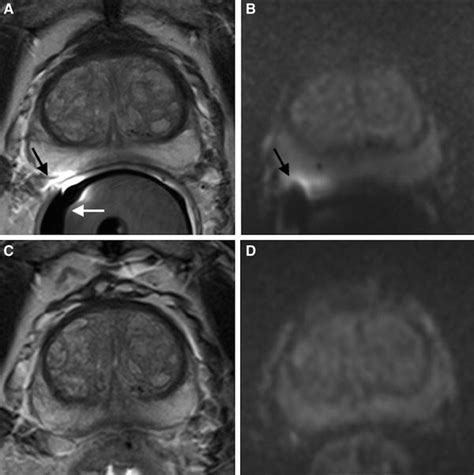Multiparametric Mri Of The Prostate Of A 72 Year Old Male Patient