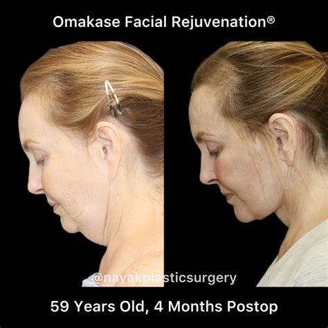 Facelift And Neck Before And After Patient 25 Nayak Plastic Surgery