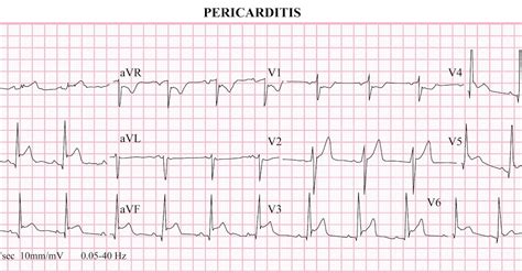 Ecg Educator Blog Pericarditis