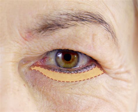 Sagging Eye Surgery Stm Style