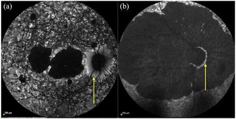 Faf Images In Patients With Abca4r A Atrophic Macula Surrounded By A