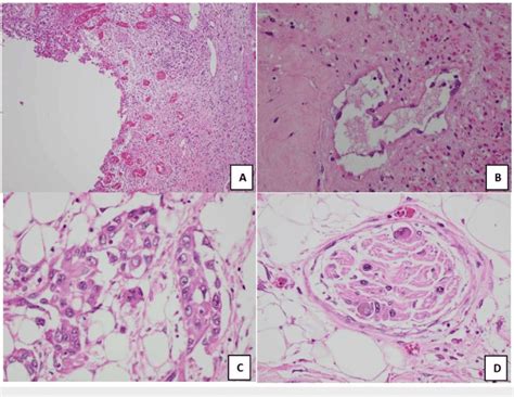 A Prostatic Urethra With Necrotic Tissue And An Ulcerated Epithelium