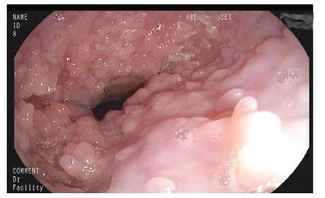 Multiple Esophageal Polyps Unusual Endoscopic Finding Of Eo Official Journal Of The