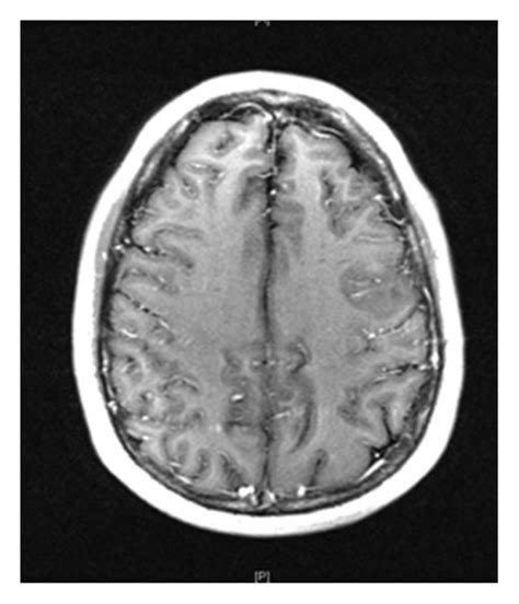Magnetic Resonance Imaging Of Head Showing Multiple Foci Of Abnormal