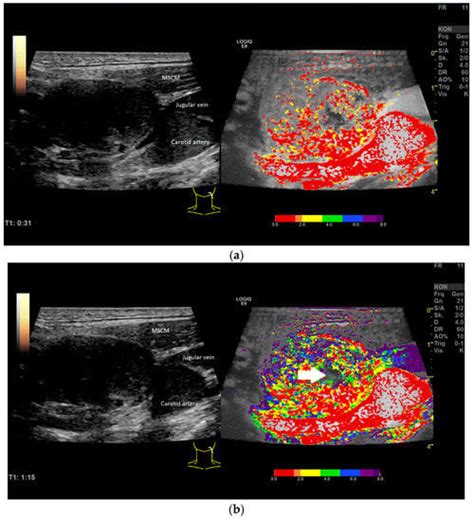 Cervical Lymphadenopathy Ultrasound Report