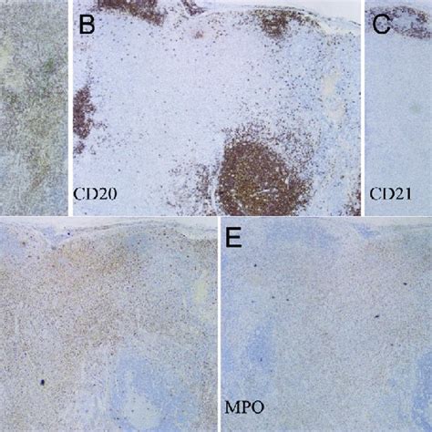 Immunohistochemistry Of The Cervical Lymph Node A Markedly Expanded