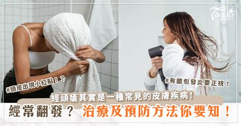 頭瘡其實是一種常見的皮膚疾病！經常翻發？治療及預防方法你要知！ 女生集合 Tagsis