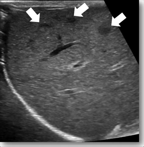 Sagittal Grayscale Ultrasound Image Demonstrates Hypoechoic Lesions