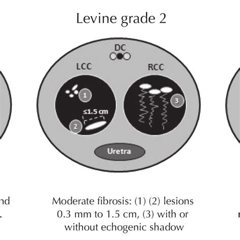 Levine Classification For Penile Fibrosis Dc Dorsal Complex Lcc