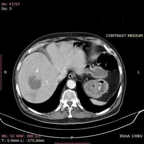 Immediate Post Ablational Ct Contrast Enhanced Imaging Of The Same Download Scientific Diagram