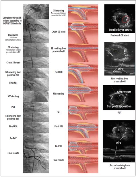A Step By Step Description Of The Dk Crush Technique Cardiac