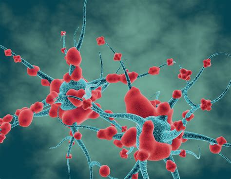 Clinical Trials Recurrent Meningioma Treatment Ivy Brain Tumor Center