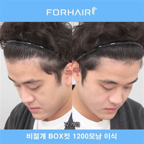 비절개 모발이식 1200모낭 M자 탈모 수술결과 비절개 모발이식 포헤어 서울 Youtube