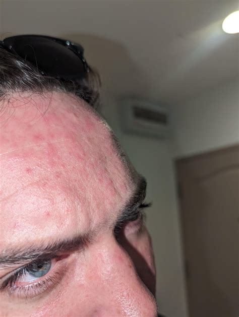 Help My Forehead Has Been Getting Worse And Worse Suddenly Aloe Vera