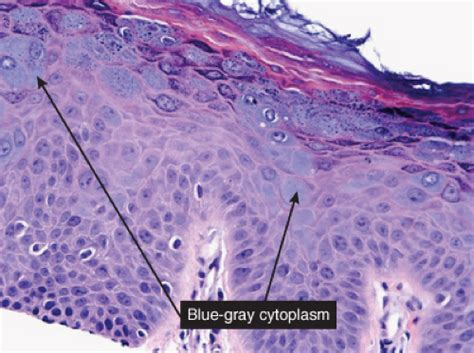 Disorders Mostly Limited To The Epidermis And Stratum Corneum Plastic