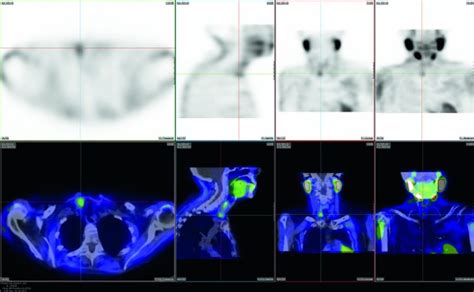 Use Of Spect Ct To Aid Parathyroid Adenoma Detection Spect Ct Images