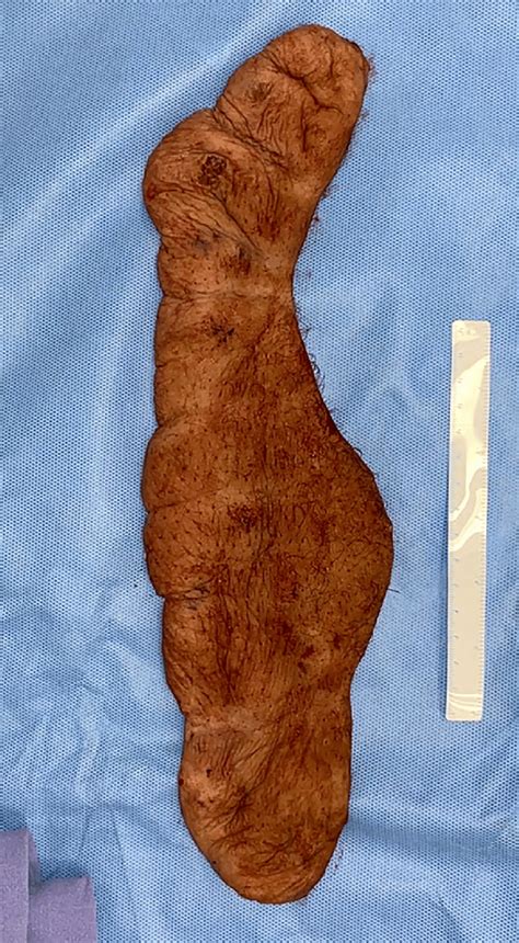 Plexiform Neurofibroma After Resection Download Scientific Diagram