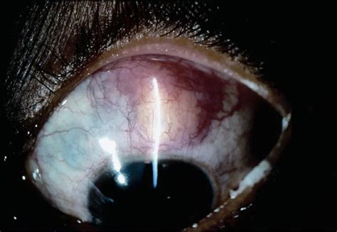 Nodular Scleritis American Academy Of Ophthalmology