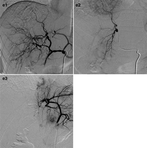 Hepatic Artery Embolizations Thoracic Key
